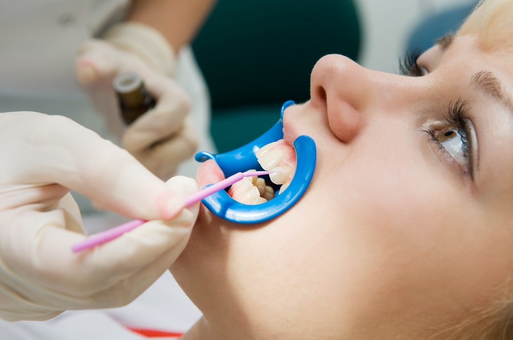 What Are The Pros And Cons Of Using Dental Sealants what-are-the-pros-and-cons-of-using-dental-sealants